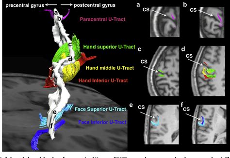 Image result for Fluency Disorder