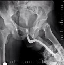 Image result for Urethrogram Technique