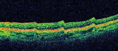 Image result for Oct Retinal Scan