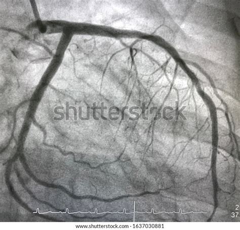 Image result for Normal Coronary Angiogram
