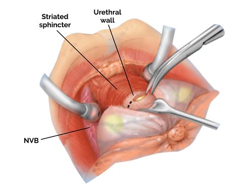 Image result for Open Radical Prostatectomy Surgery