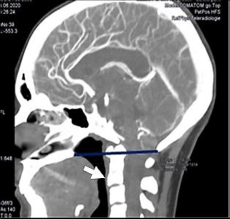 Image result for X-Rays for Basilar Invagination