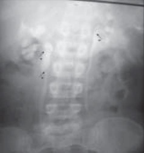 Image result for Urogram Triphasic