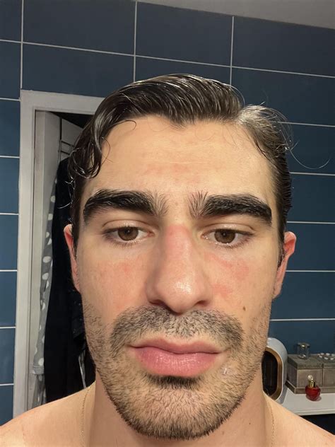 Image result for Seb Derm