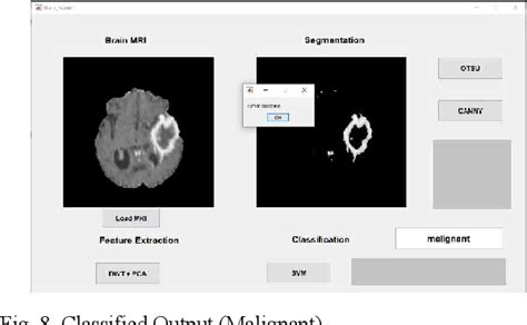 Image result for Brain Tumor Detection Classification Using SVM