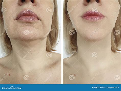 Image result for Thread Lifting Face