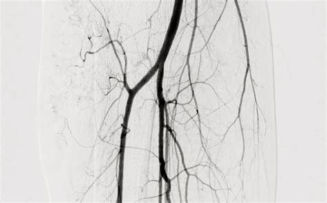 Image result for Left Lower Extremity Angiogram