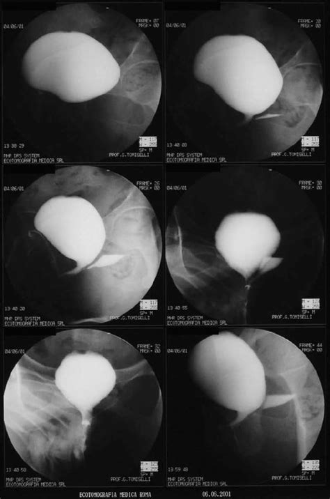 Image result for Cystourethrogram