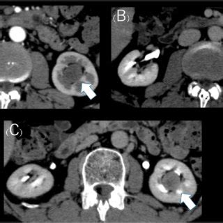 Image result for Nephrogram Phase Timing