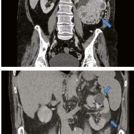 Image result for Delayed Phase CT Urogram