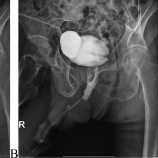 Image result for Urethrogram Procedure