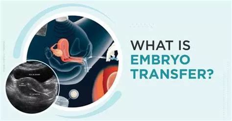 Image result for Watch Embryo Transfer