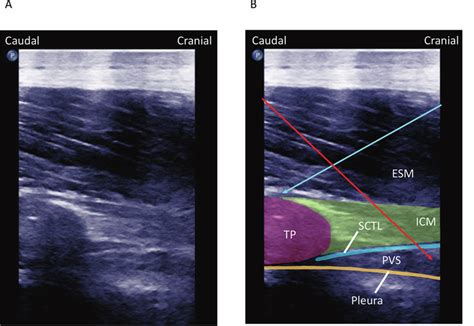 Image result for EPB Ultrasound Linear Array