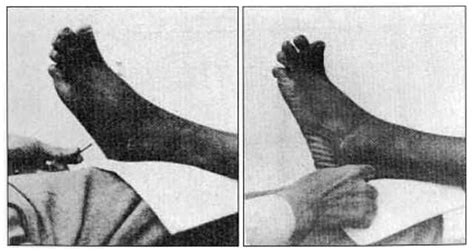 Image result for Chaddock Reflex Video