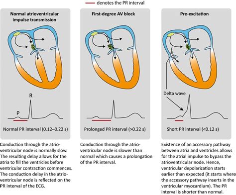 Image result for PR Interval Abnormalities