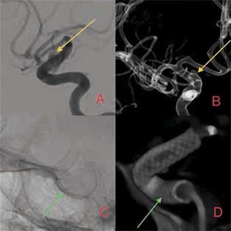 Image result for Radial Loop Angiogram