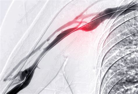 Image result for Heart Block Angiogram