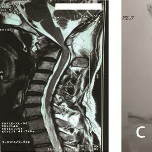 Image result for X-Rays for Basilar Invagination