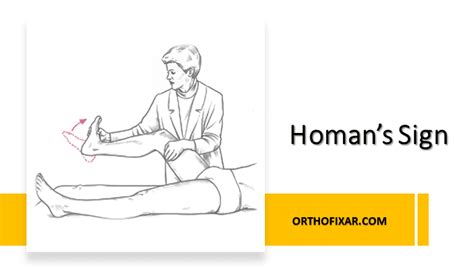 Homans Sign Test Explained Easily | OrthoFixar