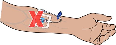 Image result for IV Line Infiltration