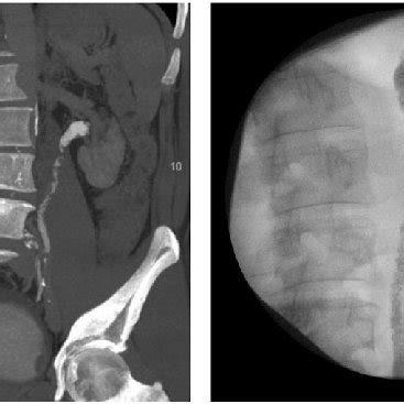 Image result for Volume-Rendered CT Urogram