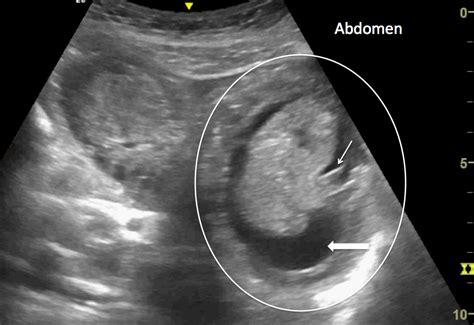 Image result for Intussusception Pseudokidney Sign