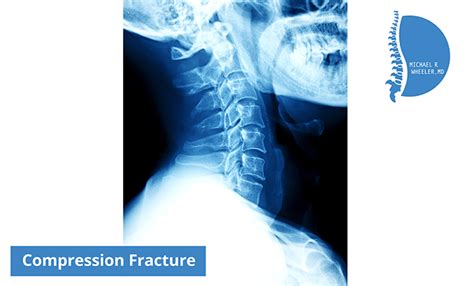 Image result for Surgery for Compression Fracture