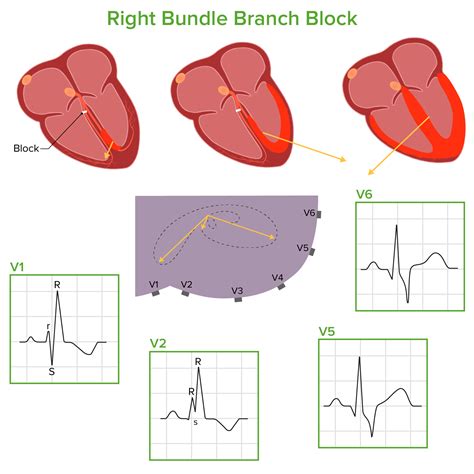 Image result for Incomplete Bundle Branch Block Left Treatment