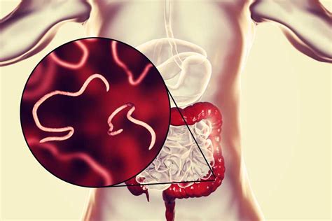 Image result for What Is Pinworm