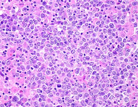 Image result for Diffuse Large Cell Lymphoma