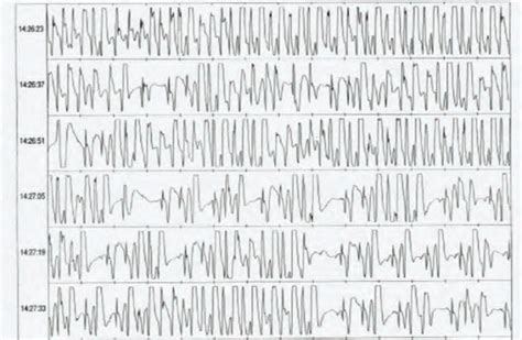 Image result for Loop Recorder Patient
