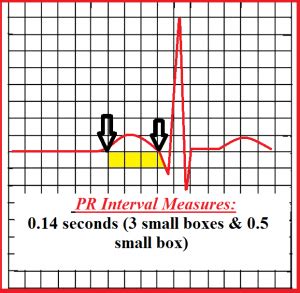 Image result for Paediatric PR Interval