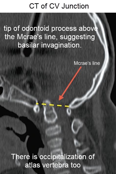 Image result for X-Rays for Basilar Invagination