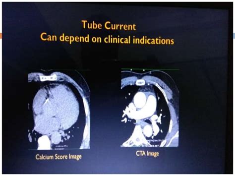 Image result for Normal Coronary CT Angiogram