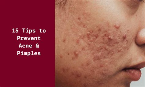 Image result for How to Avoid Pimples