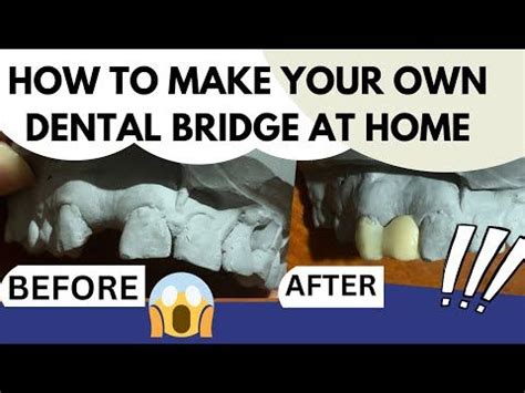 Image result for DIY Tooth Bridge Kit