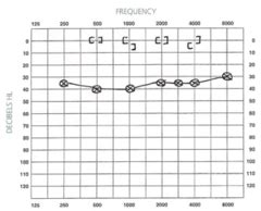 Image result for How to Perform Bone Conduction Testing