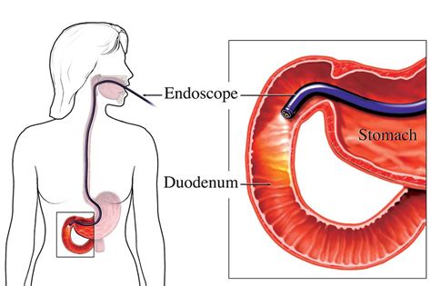 Image result for Endoscopy Small Intestine
