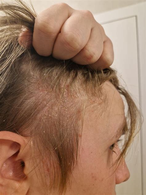 Image result for Seb Derm