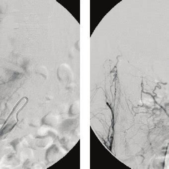 Image result for Angiogram with Embolization