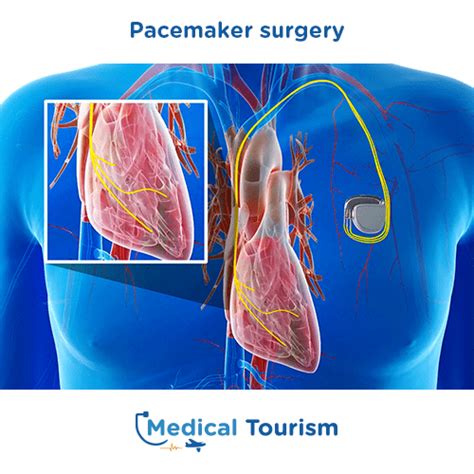 Image result for Recovery After Pacemaker Surgery