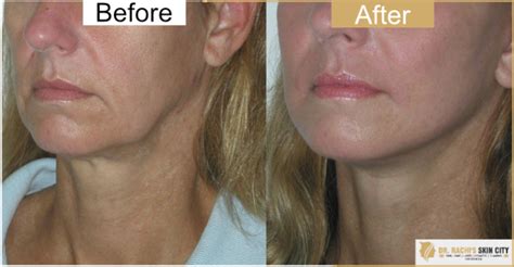 Image result for Thread Lifting Face