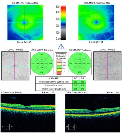 Image result for Oct Retinal Scan Interpretation