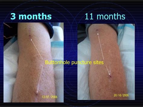 Image result for Buttonhole Invagination