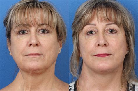 Image result for Reconstructive Surgery Procedure