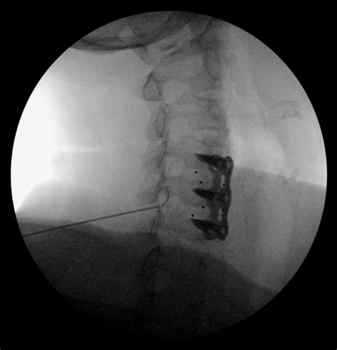 Image result for Cervical Steroid Injection