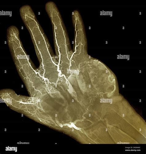 Image result for Hand Angiogram