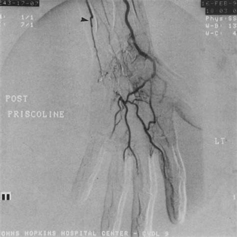 Image result for Hand Angiogram