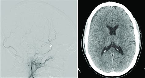 Image result for Angiogram with Embolization