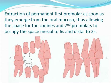 Image result for Serial Extraction Case Report